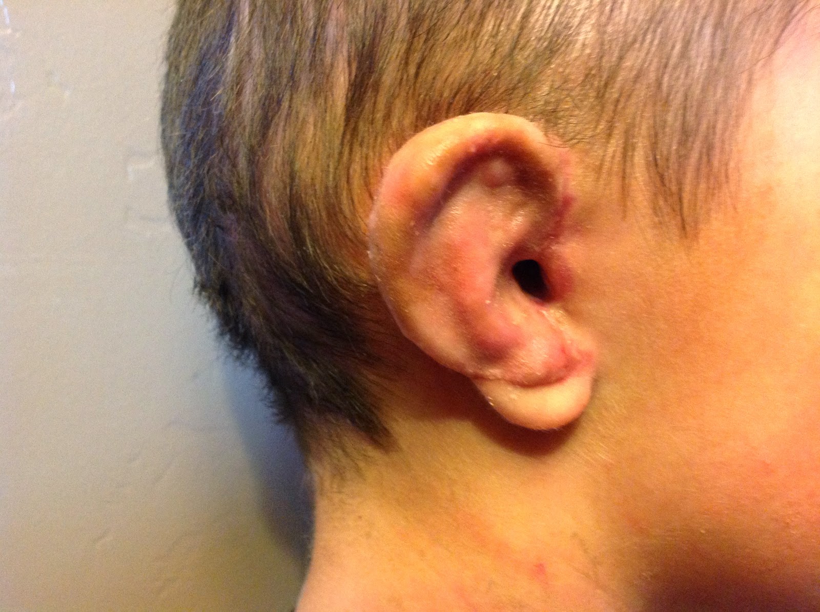 Microtia: Microtia Rib Cartliage Ear Surgery done in only ONE surgery!