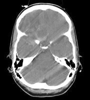 ABC Radiology Blog: Computed Tomography Artifacts
