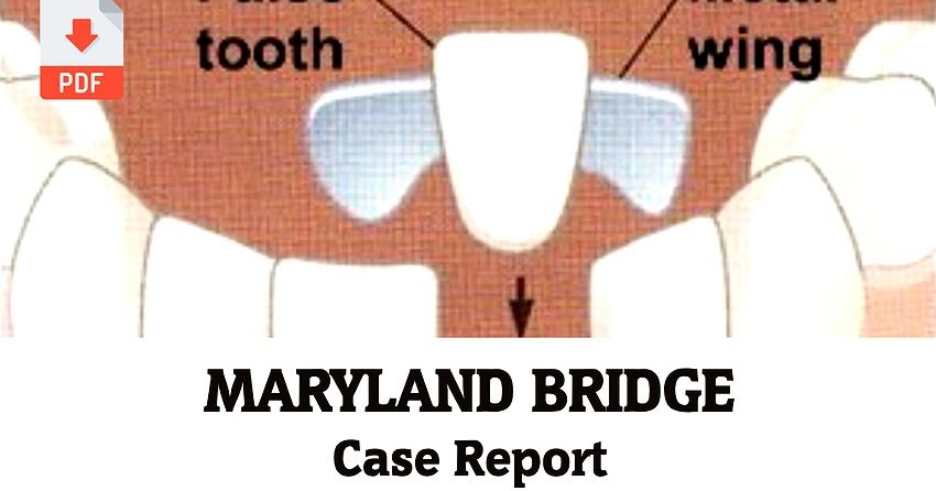 PDF: Maryland Bridge - Case Report - Ovi Dental