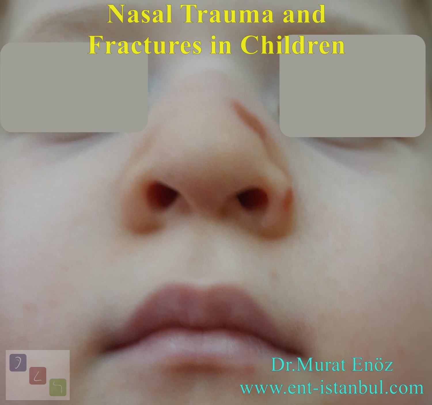 Nasal Fractures - Causes, Symptoms, Diagnosis, Treatment