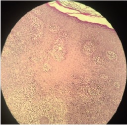 Case Of Giant Condyloma Acuminatum Of Buschke- Löwenstein: OAJBS Publishers