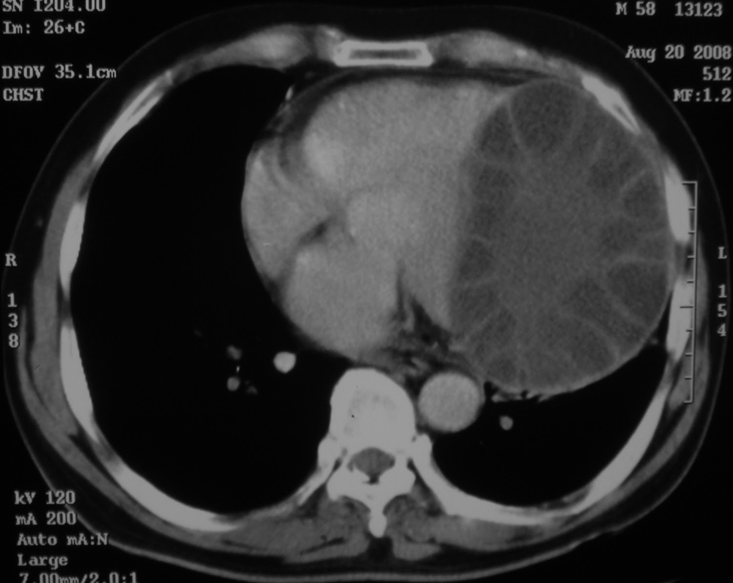 Medical Science: What is Hydatid cyst? Investigations and treatment.