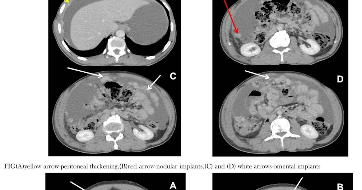 RADIOLOGICAL FINDINGS :PERITONEAL CARCINOMATOSIS - Sumer's Radiology Blog
