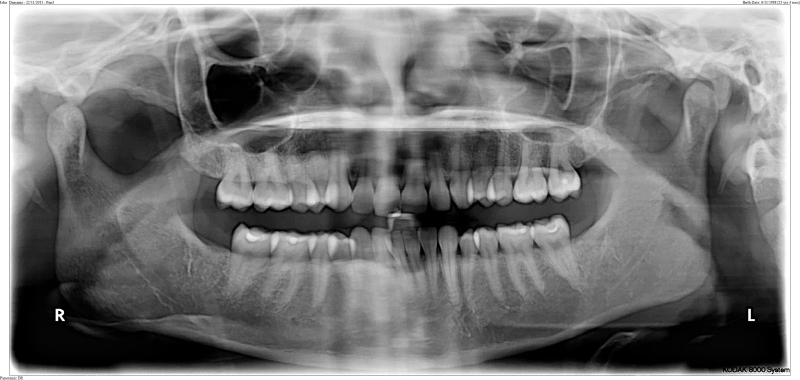 Toronto Invisalign - Brand New Smile :): Interproximal Reduction (IPR ...