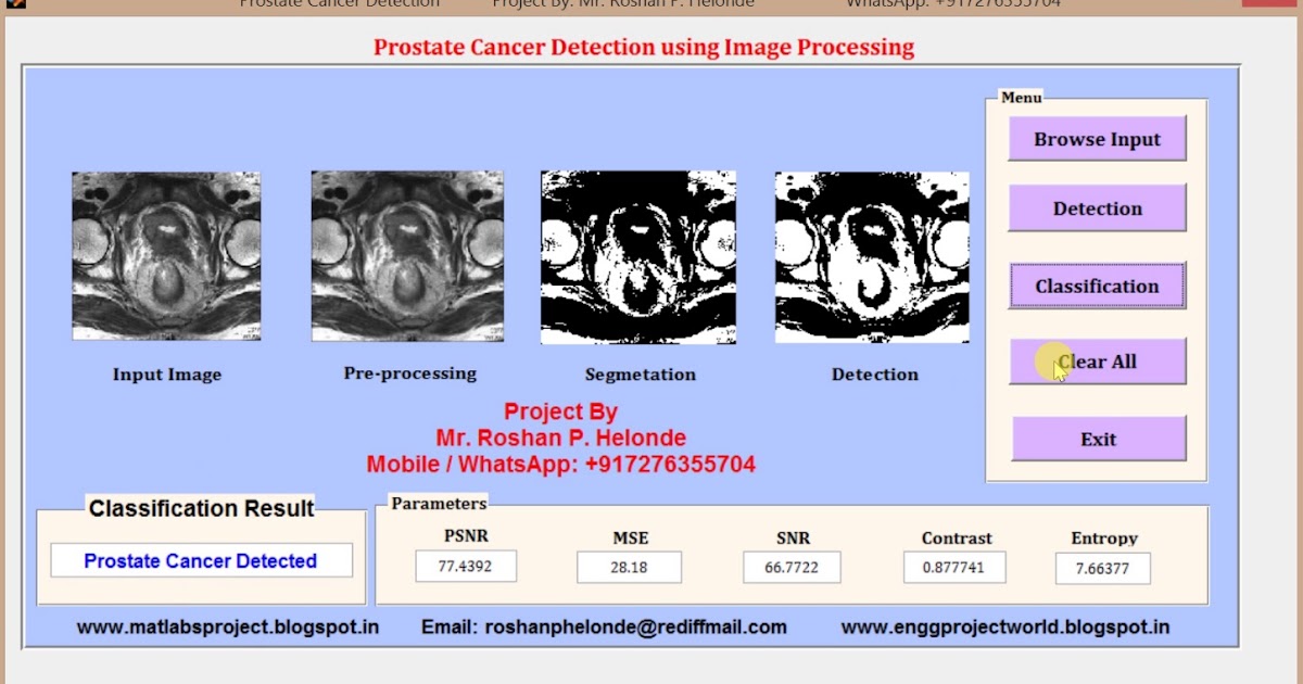 Prostate Cancer Detection Using Image Processing Matlab Source Code