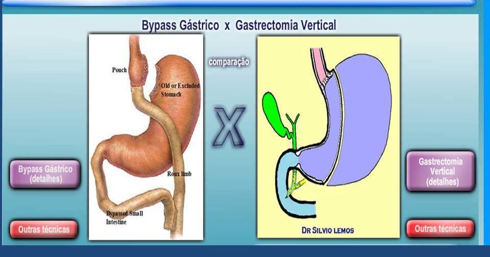 Diário e dicas sobre a cirurgia bariátrica (A minha cirurgia bariátrica ...