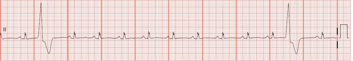 EKG Rhythm Strip Quiz 20