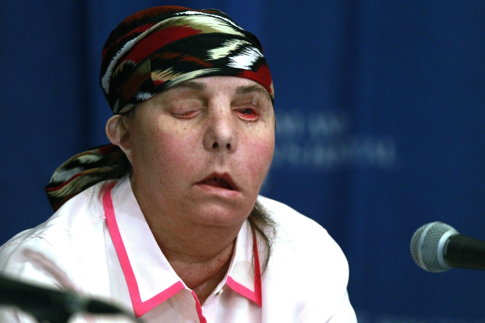 Meet The First Woman To Have A Face Transplant (Replaced Face) In The World