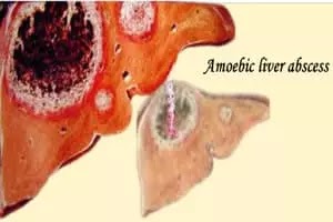 Amoebic liver abscess - Symptoms, Treatment