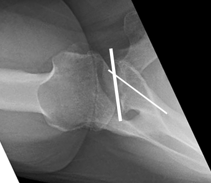 UW Shoulder and Elbow Academy: Ream and run, glenoid version and ...