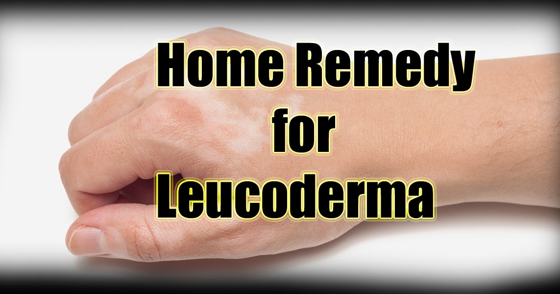 Top 14 Home Remedy for Leucoderma - Natural Remedies And Treatment