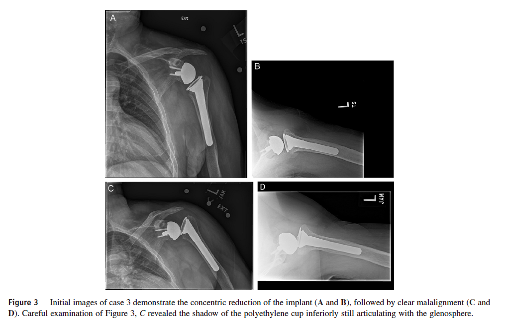 UW Shoulder and Elbow Academy: Reverse total shoulder - failure by ...