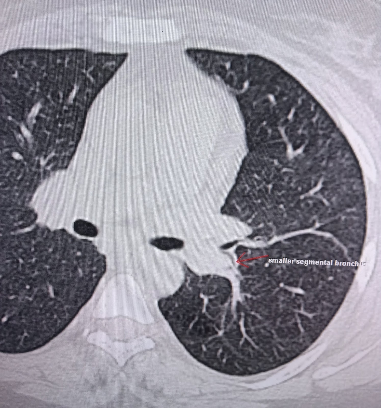 Segmental bronchial atresia-Case Report - Sumer's Radiology Blog