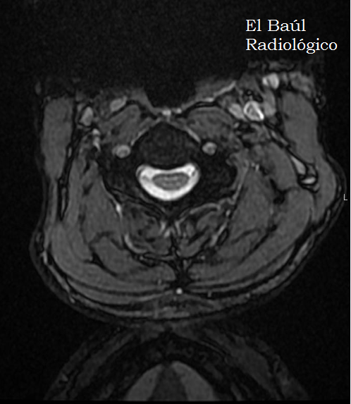 El Baúl Radiológico: ARTEFACTOS POR SUPERPOSICIÓN EN EL SENTIDO DE LA ...