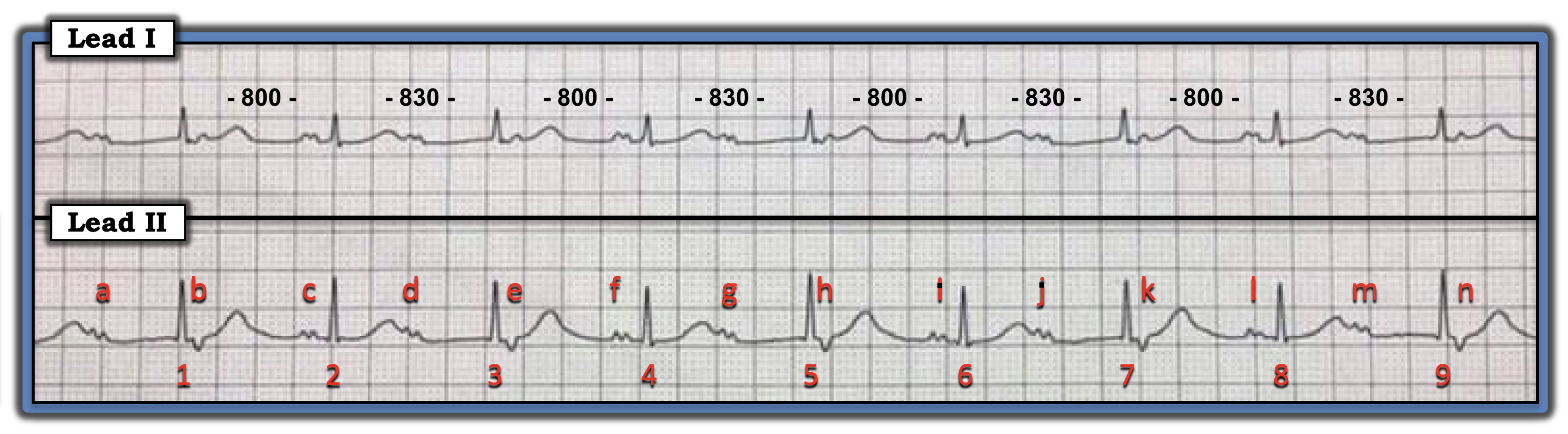 ECG Interpretation: ECG Blog #239 (54) — Why 2 Kinds of P Waves?