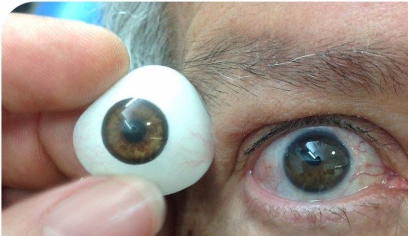 ¿Por que una prótesis ocular personalizada?