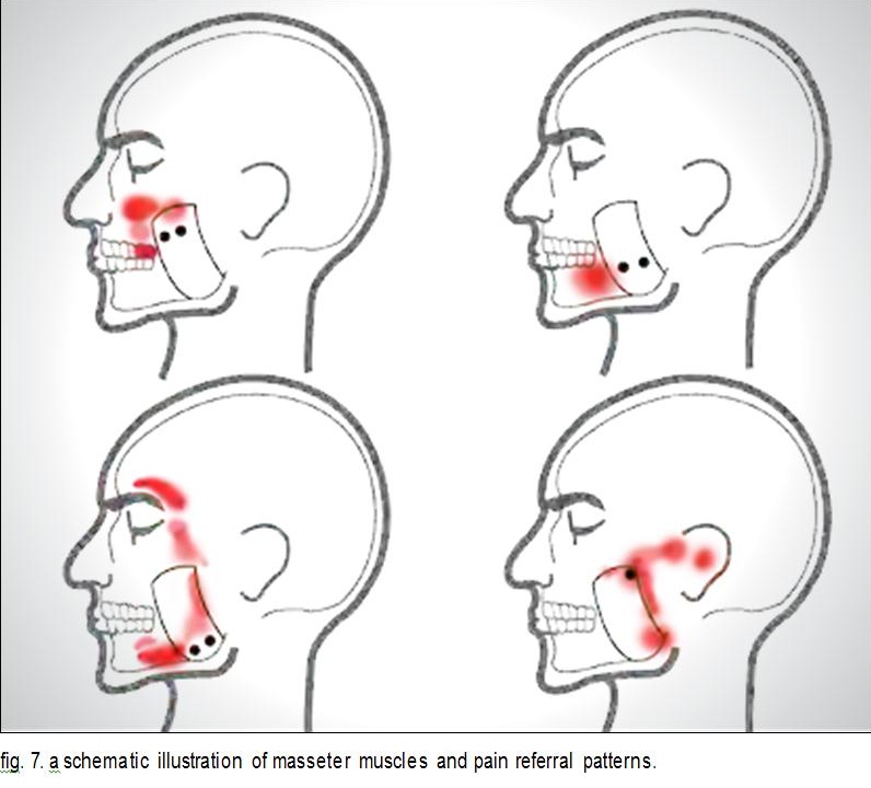 Myofascial pain - What is this orofacial pain? How fixed?