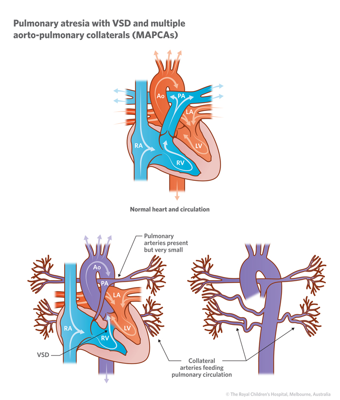 Play It Where It Lies: Congenital Heart Defect--Pulmonary Atresia