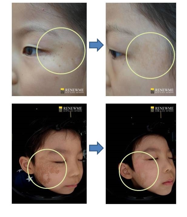 Renewme Skin Clinic: Birthmark, Café-Au-Lait Spot removal Laser treatment