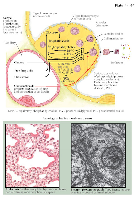 RESPIRATORY DISTRESS SYNDROME - pediagenosis