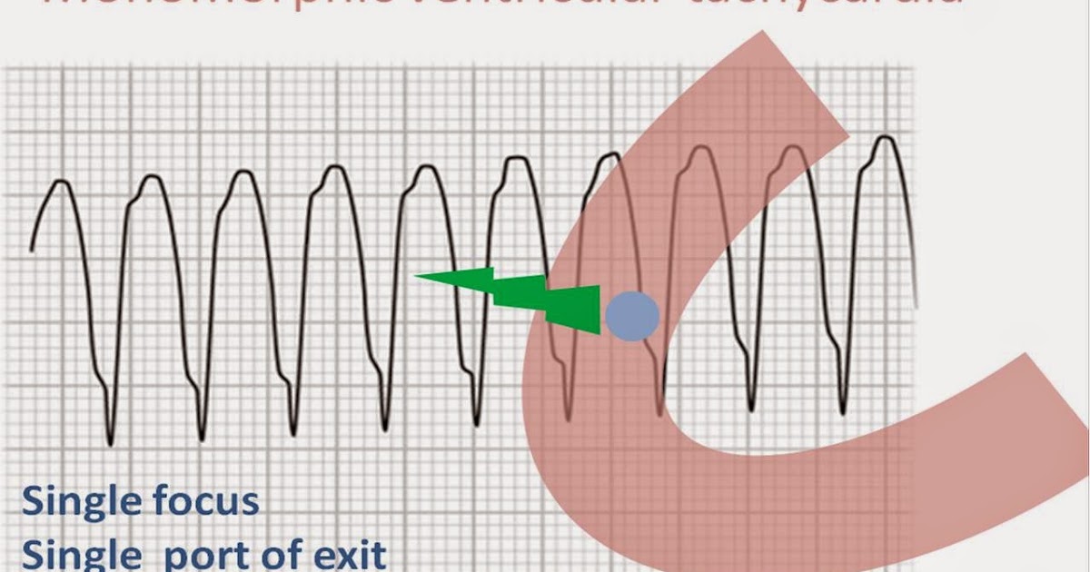 Monomorphic Ventricular Tachycardia | INA - ECG