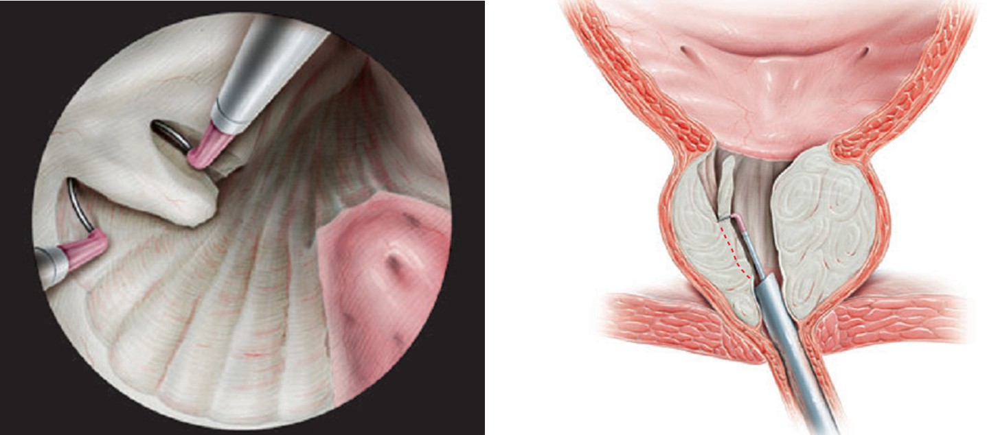 How To Perform TURP post Step by step Operative Urology Series How To Perform TURP post Step by step Operative Urology Series