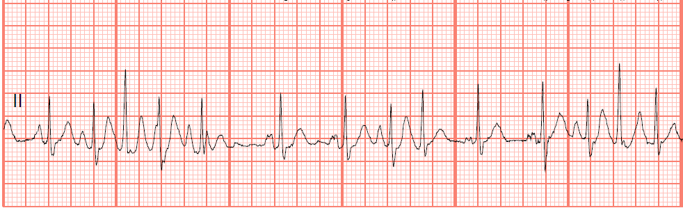 EKG Quiz 370 Identify these fast rhythms