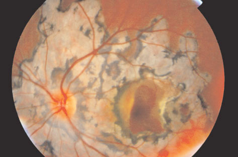 La Coroiditis Serpiginosa, una afección ocular poco frecuente - Por Una ...