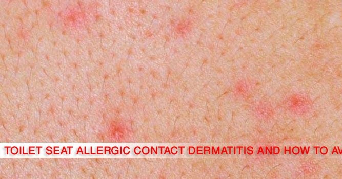 Medical Raised Toilet Seat: Toilet Seat Allergic contact dermatitis And ...