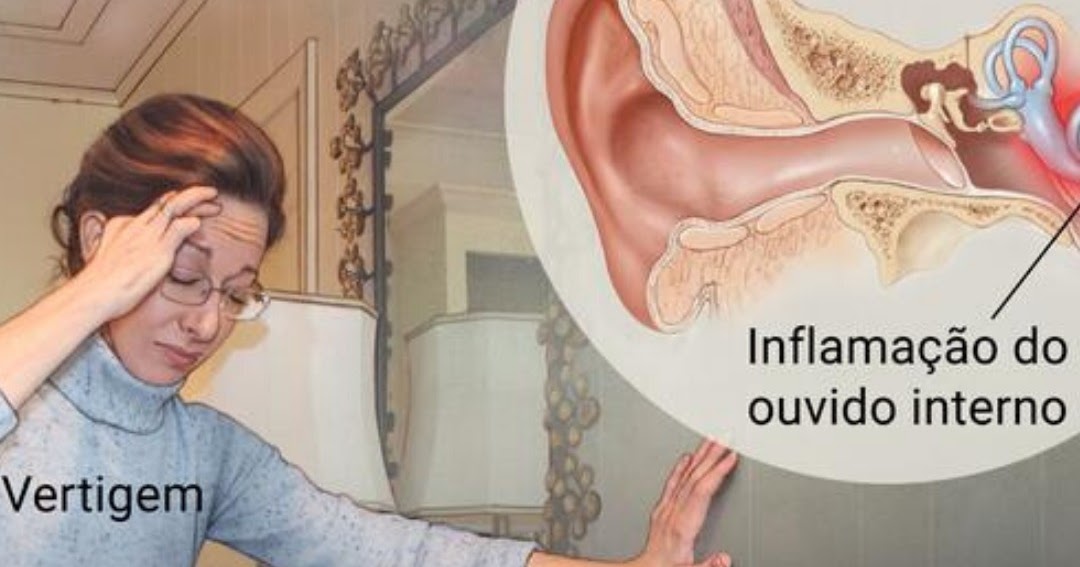 Labirintite é uma palavra que significa inflamação do Labirinto