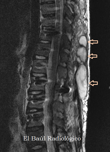 El Baúl Radiológico: SEROMAS POSTQUIRÚRGICOS PARAVERTEBRALES (Lumbar ...