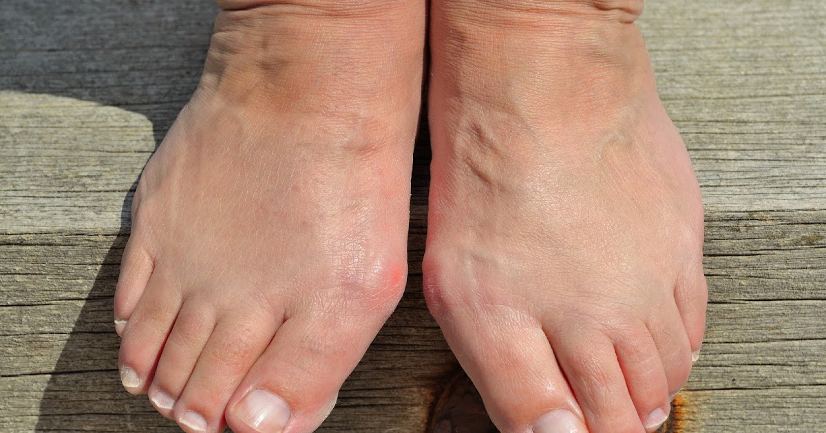 Foot and Ankle Problems By Dr. Richard Blake: Awesome Toes vs. Correct ...