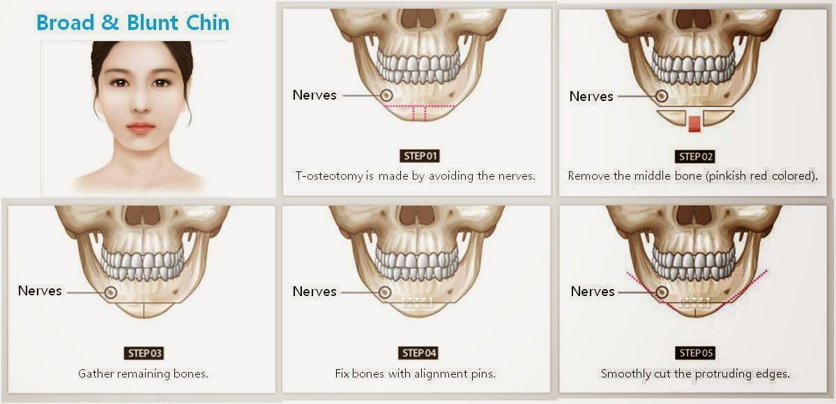 ID Hospital Korea: What is Mini V-Line Surgery?