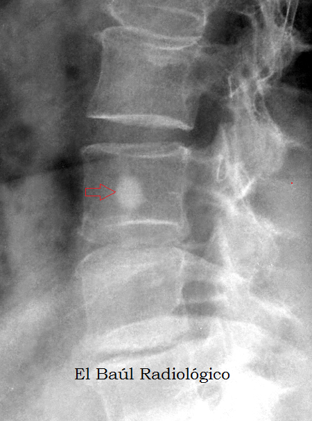 El Baúl Radiológico: ENOSTOSIS: ISLOTE ÓSEO (Bone Island: CT and MRI ...