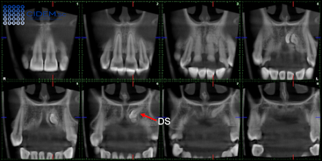 CIDEM: DIENTE SUPERNUMERARIO ASOCIADO A ODONTOMA COMPUESTO