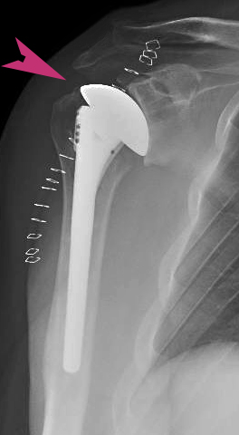 UW Shoulder and Elbow Academy: The humeral component: what's in a stem?