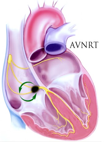 (POKROČILÍ) AVNRT versus AVRT - Kardioblog