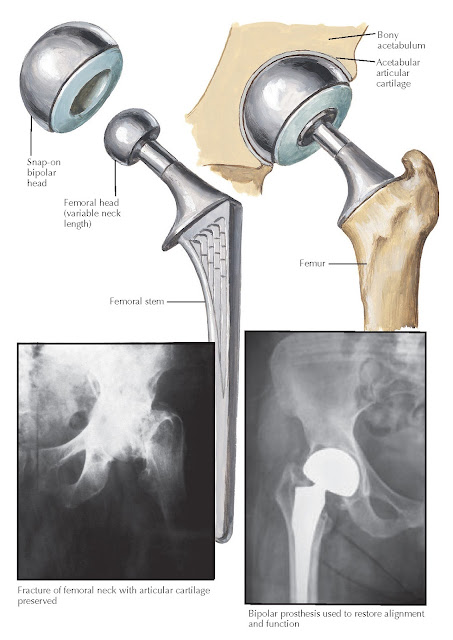 TOTAL HIP REPLACEMENT: HEMIARTHROPLASTY OF HIP - pediagenosis