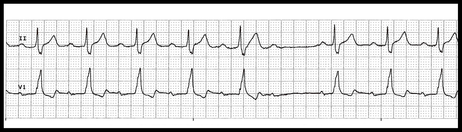 Basic EKG Rhythm Test 34