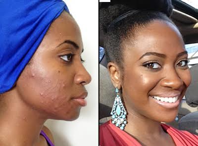 Finally in Naija! Magical Japanese cream that fades off black spots ...