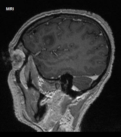 Diffuse astrocytoma (WHO Grade II)