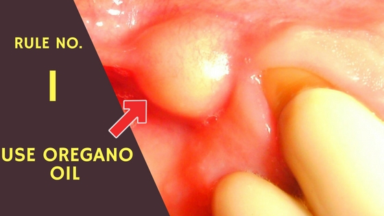 Cure Tooth Abscess Naturally With This 1 Powerful Technique