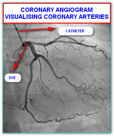 Angiography Blockage