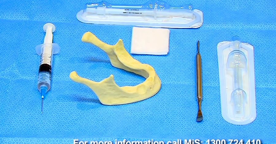 IMPLANTOLOGY: Bone Grafting simplified with BondBone - Odonto-Tv