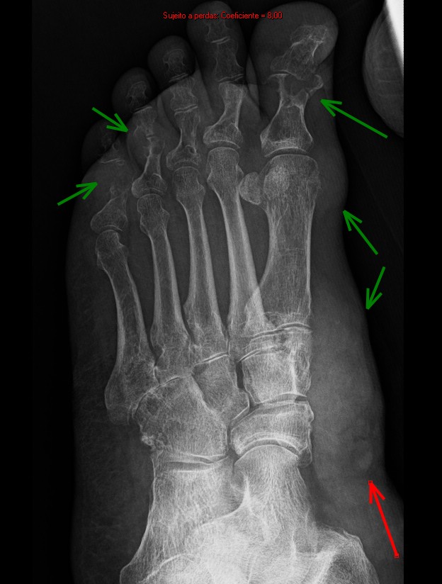 Chronic Tophaceous Gout.