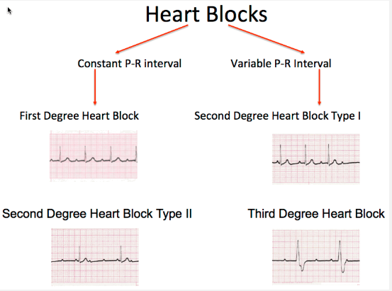 Heart Block