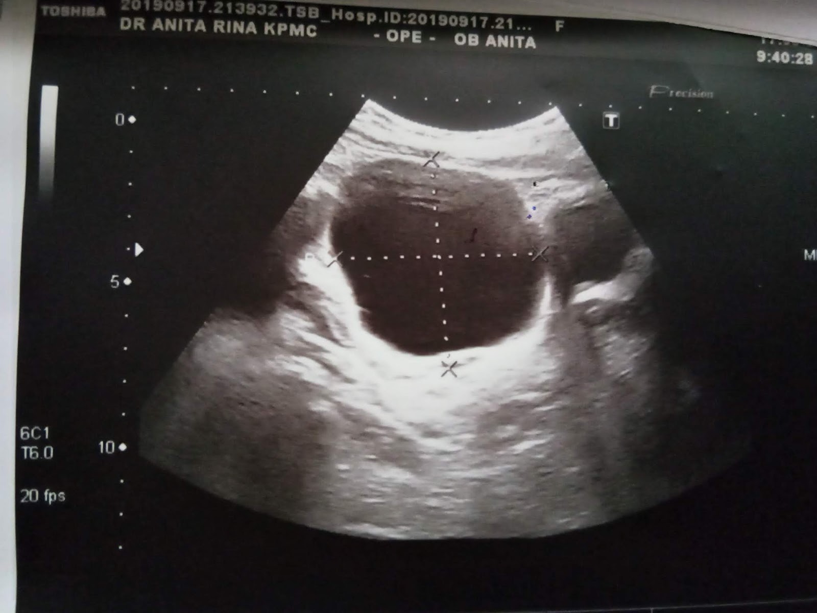 ~ SIS LIN SHARE ~: Buang Cyst 7cm (Laparoscopy Surgery)