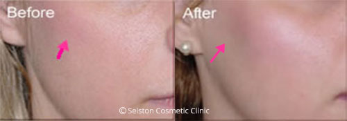 Selston Cosmetic Clinic: Restore Volume to Sunken Cheeks With Dermal ...