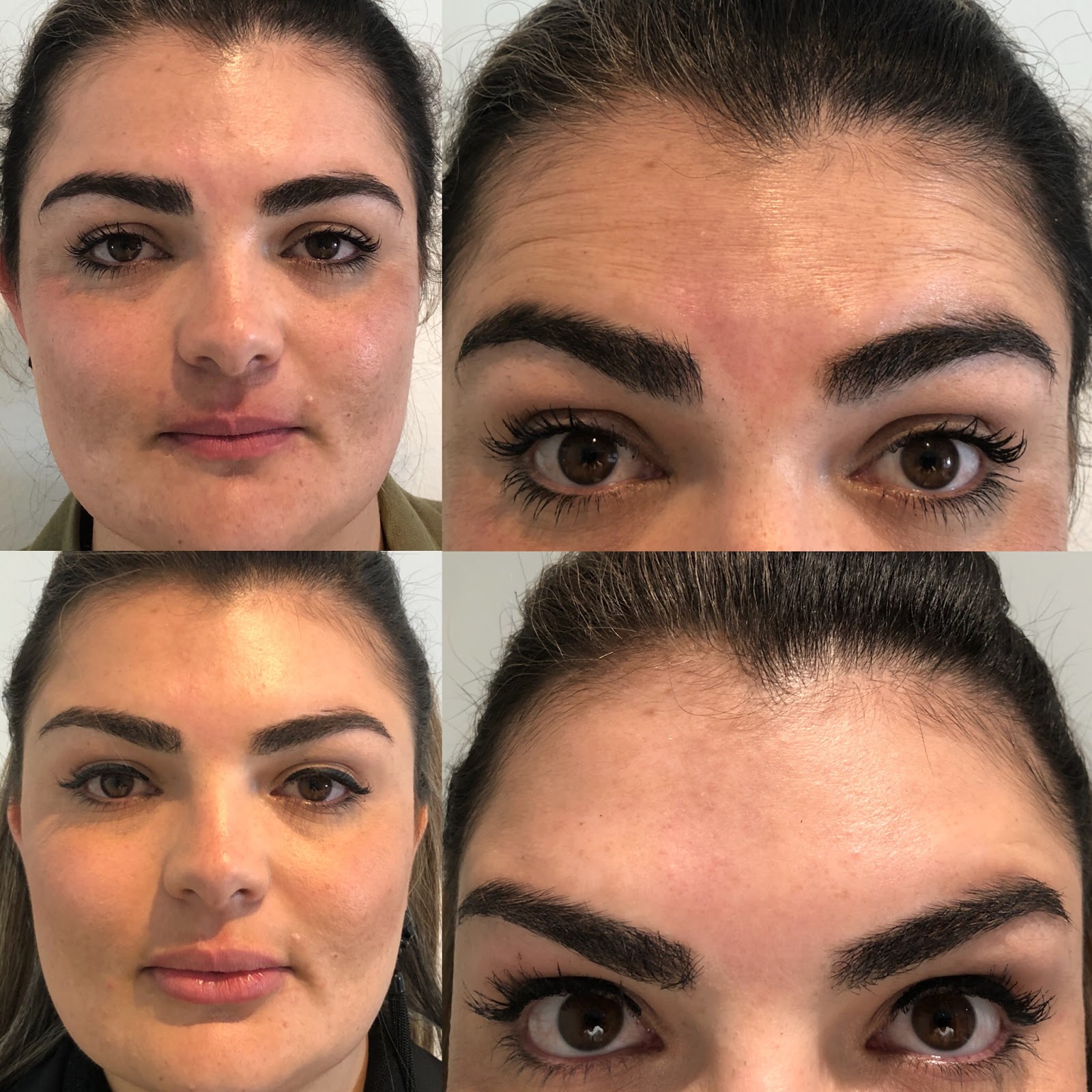 REPORTAJE HIPERACTIVO: MITOS Y VERDADES DEL BOTOX, EL TRATAMIENTO ...