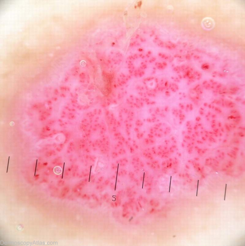 Dermoscopy Features as Clues: Dots Red